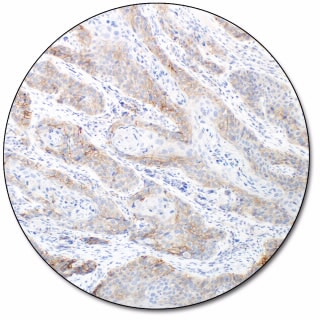 PD-L1 IHC 28-8 pharmDx for Autostainer Link 48 | Agilent